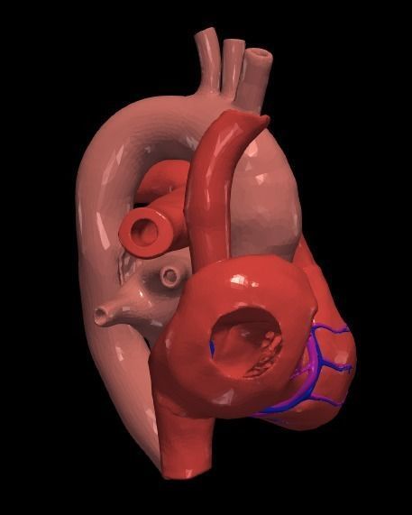 3d model of heart with atrial septal defect 3D model | CGTrader