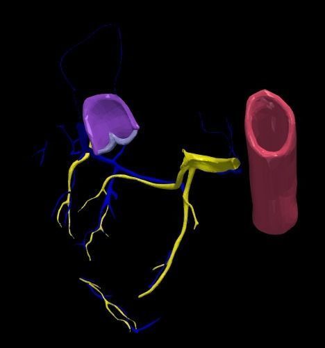 3d model of heart with atrioventricular septal defect 4 chamber 3D ...