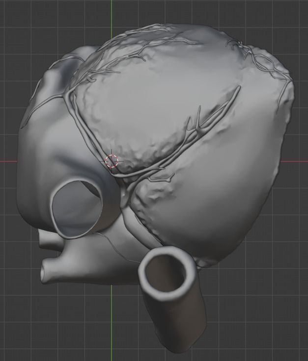 3d model of heart with atrioventricular septal defect 4 chamber 3D ...