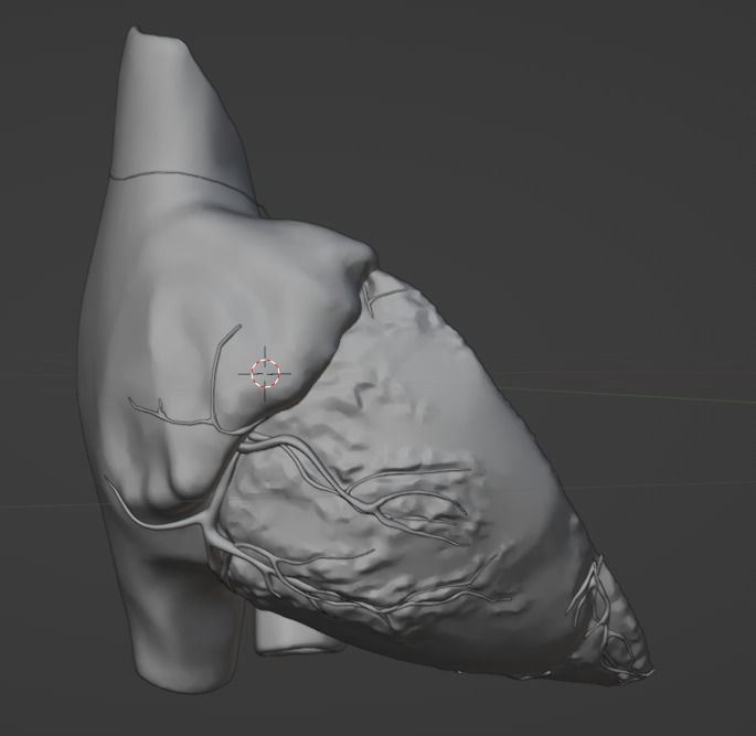 3d model of heart with atrioventricular septal defect 4 chamber 3D ...