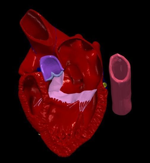 3d model of heart with atrioventricular septal defect 4 chamber 3D ...