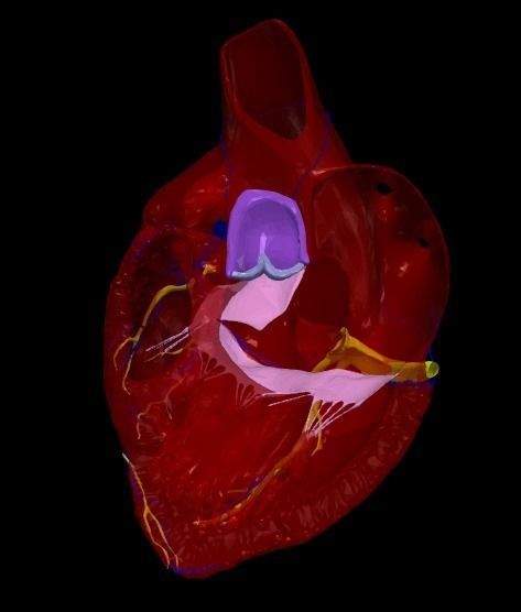 3d model of heart with atrioventricular septal defect 4 chamber 3D ...
