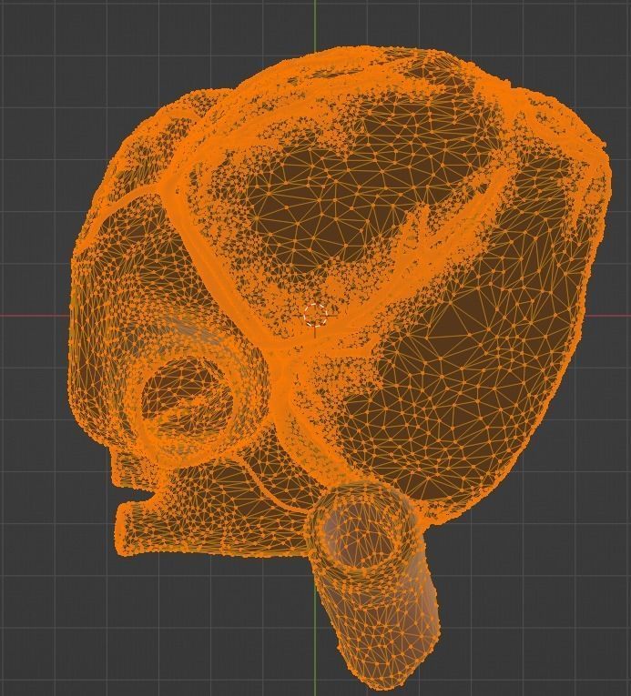 3d model of heart with atrioventricular septal defect 4 chamber 3D ...