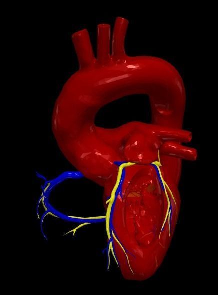 3d model of heart with atrial septal defect 3D model 3D printable ...