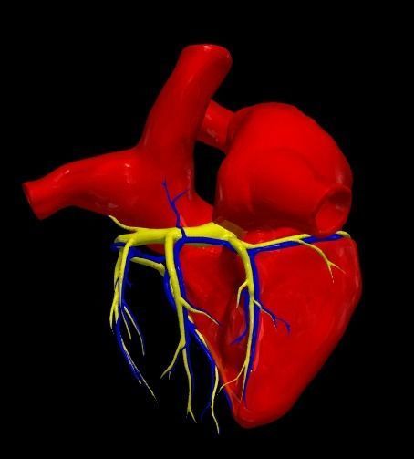 3d model of heart with atrial septal defect 3D model 3D printable ...