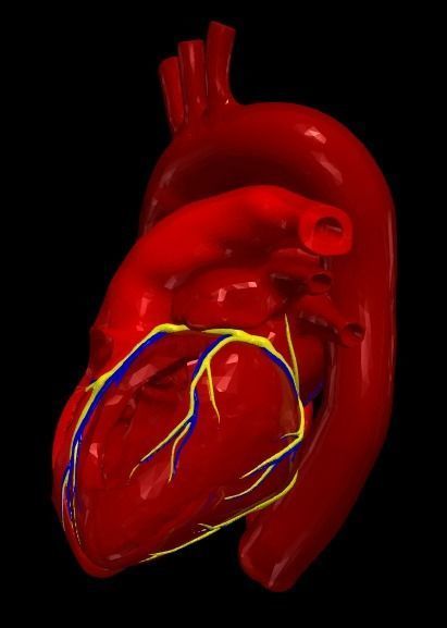 3d model of heart with atrial septal defect 3D model 3D printable ...