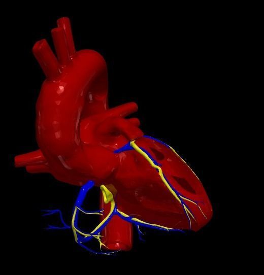 3d model of heart with atrial septal defect 3D model 3D printable ...
