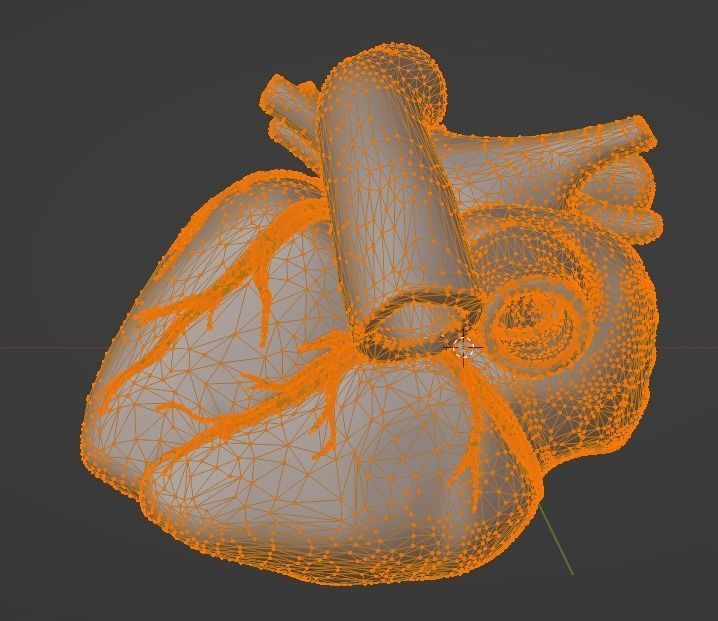 3d model of heart with atrial septal defect 3D model 3D printable ...