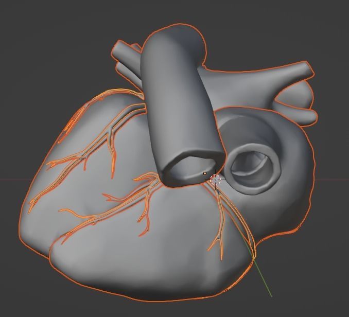 3d model of heart with atrial septal defect 3D model 3D printable ...