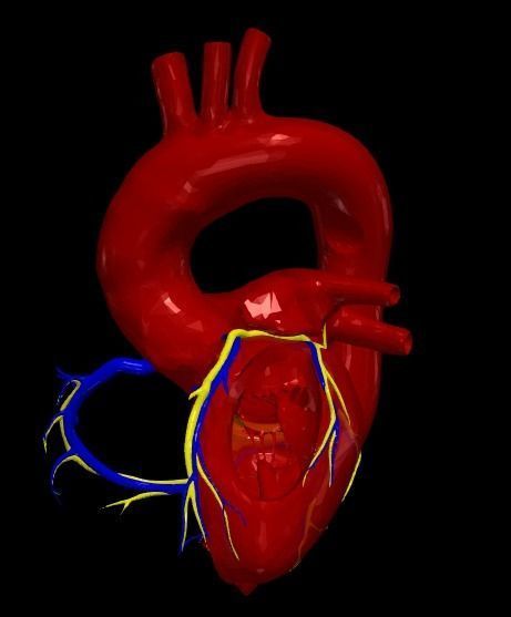 3d model of heart with atrial septal defect 3D model 3D printable ...