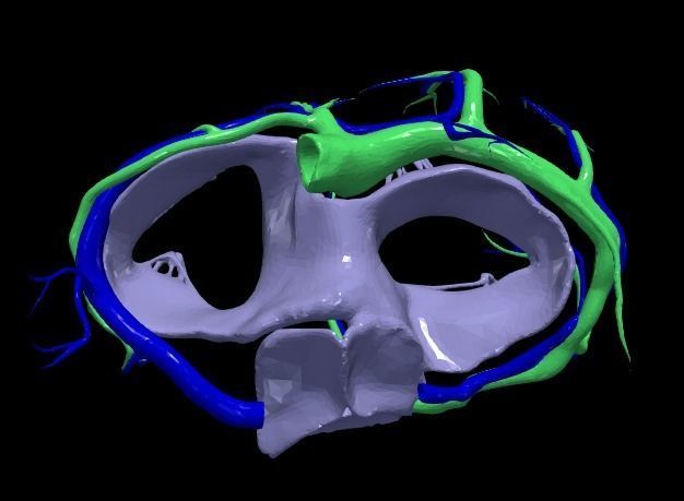 3d model of heart with common arterial trunk 3D model 3D printable ...