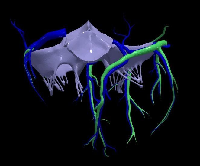 3d model of heart with common arterial trunk 3D model 3D printable ...