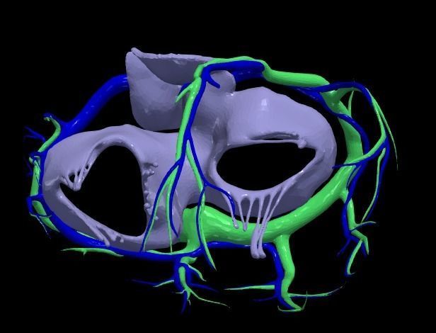 3d model of heart with common arterial trunk 3D model 3D printable ...