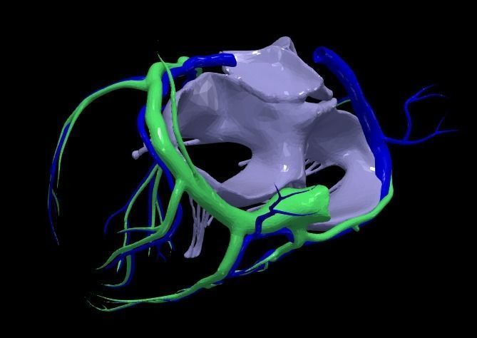 3d model of heart with common arterial trunk 3D model 3D printable ...