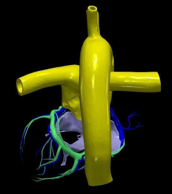 3d model of heart with common arterial trunk 3D model 3D printable ...