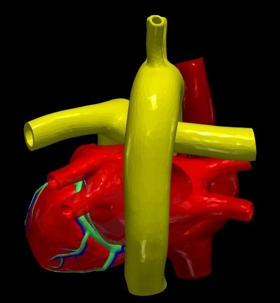 3d model of heart with common arterial trunk 3D model 3D printable ...