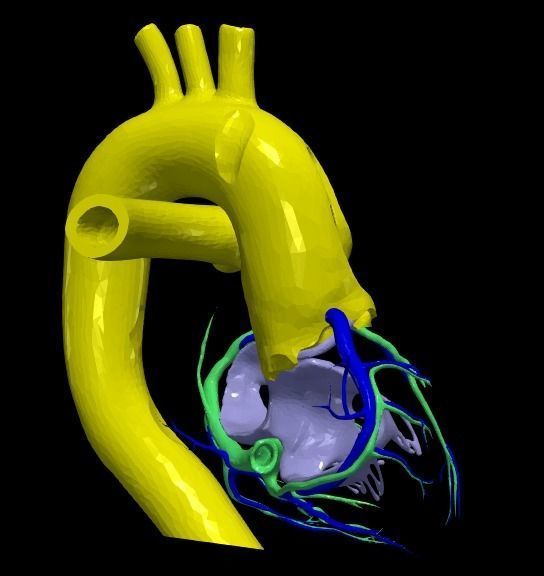 3d model of heart with common arterial trunk 3D model 3D printable ...