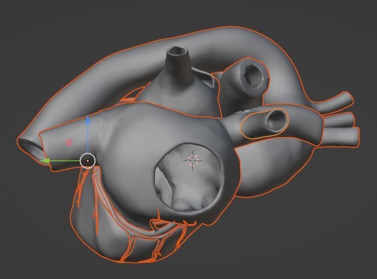 3d model of heart with PAPVC 3D model 3D printable | CGTrader