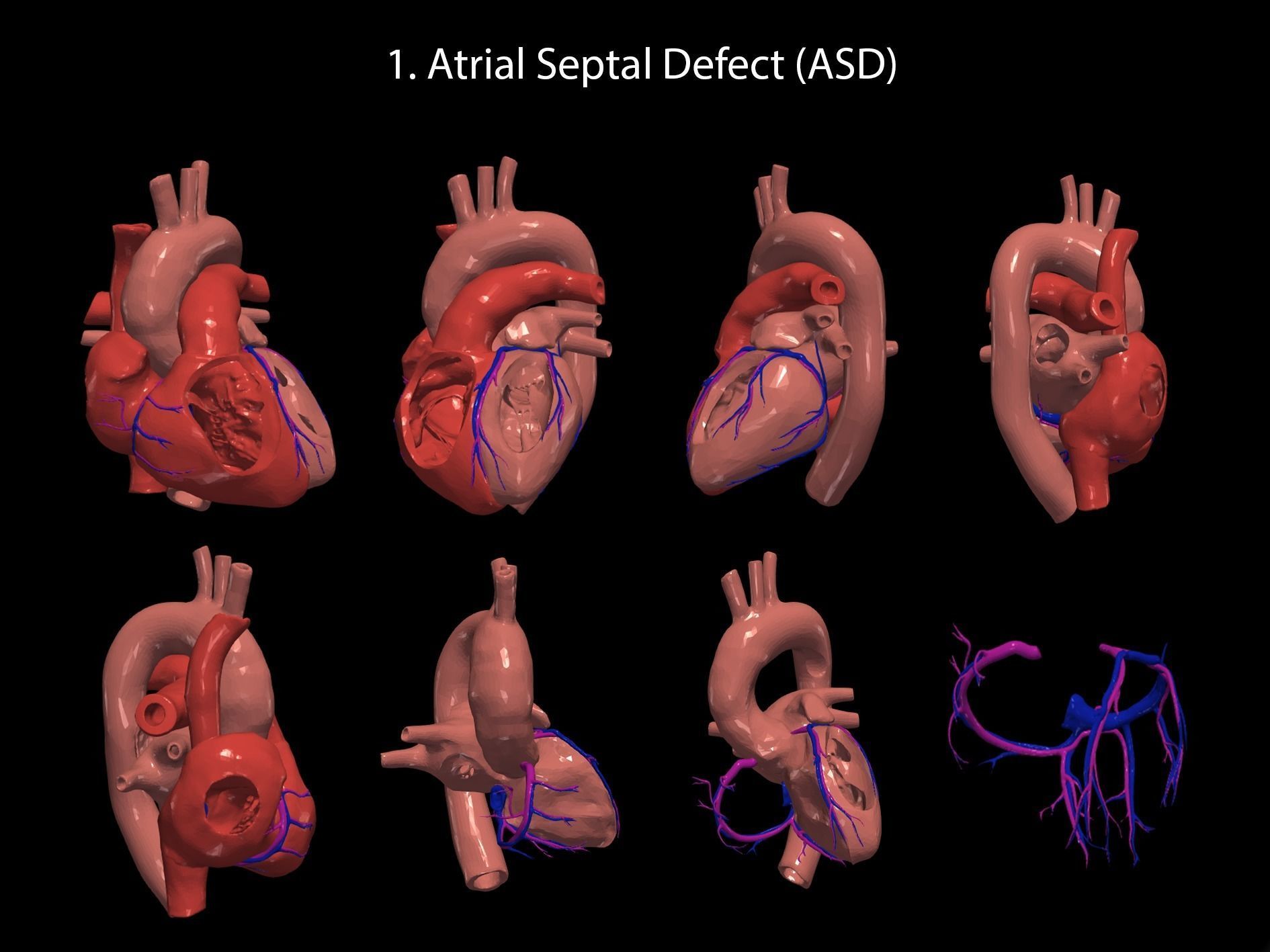 Congenital Heart Disease - 7pack 3D model | CGTrader