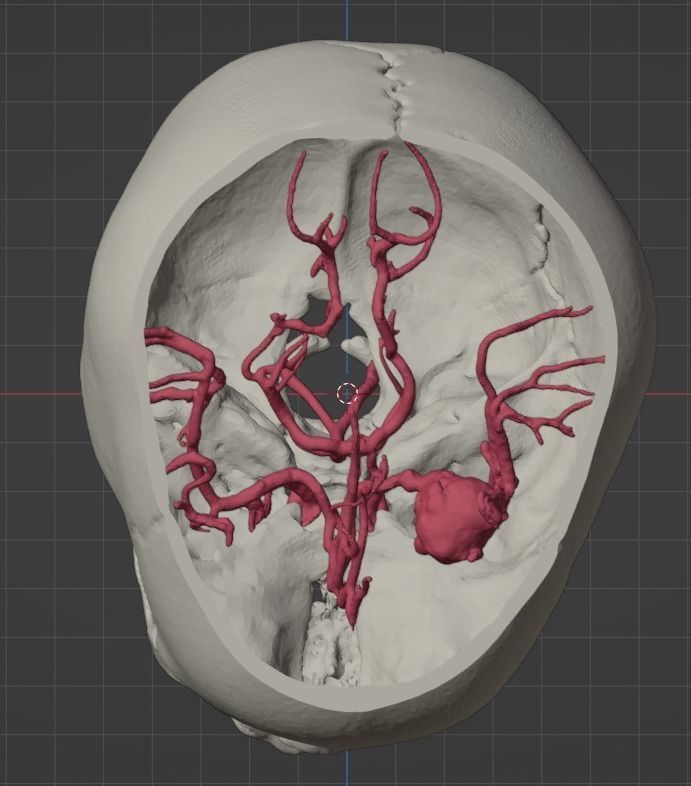 3D Model of Middle Cerebral Artery Aneurysm 3D model 3D printable ...