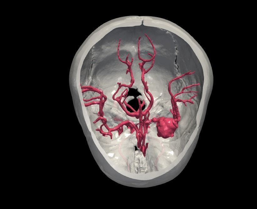 3D Model of Middle Cerebral Artery Aneurysm 3D model 3D printable ...