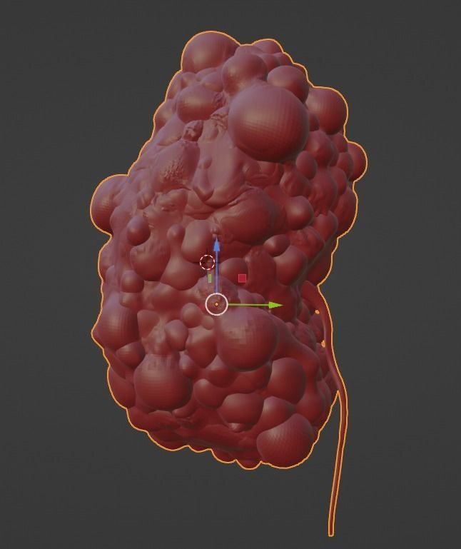 3D Model of Polycystic Kidney 3D model | CGTrader