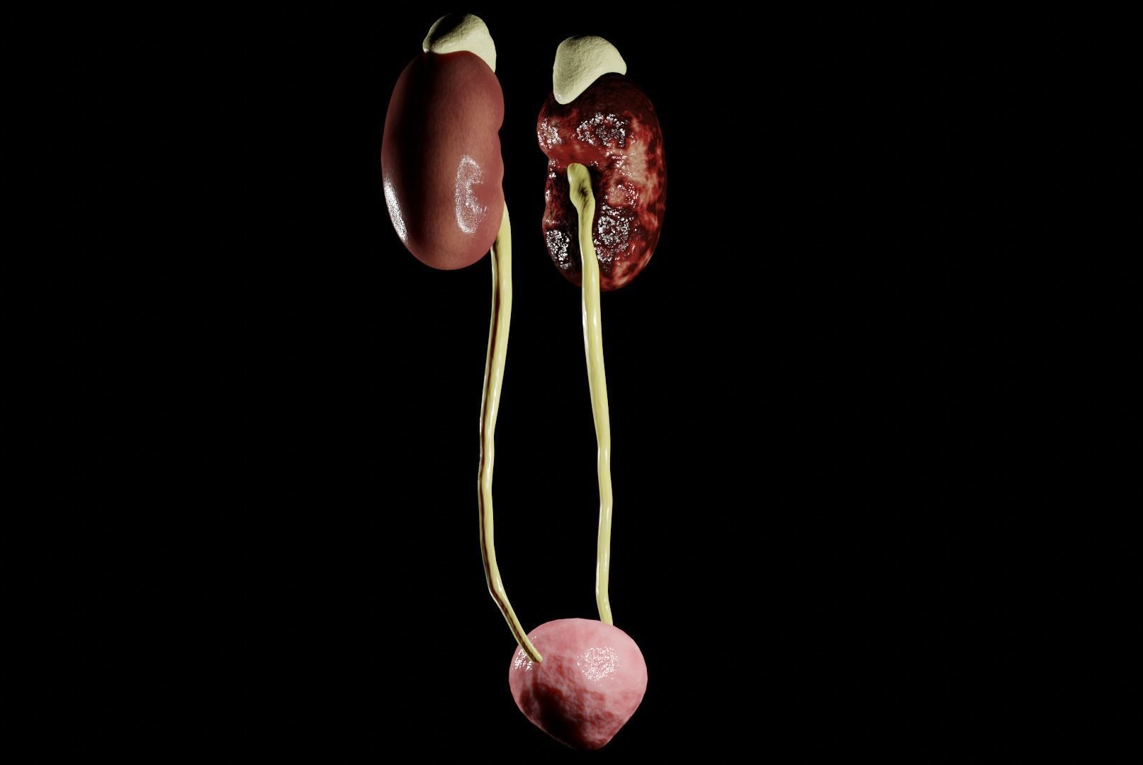 Human Kidney and Urinary System 3D model RENAL CANCER TUMOR 3D model ...