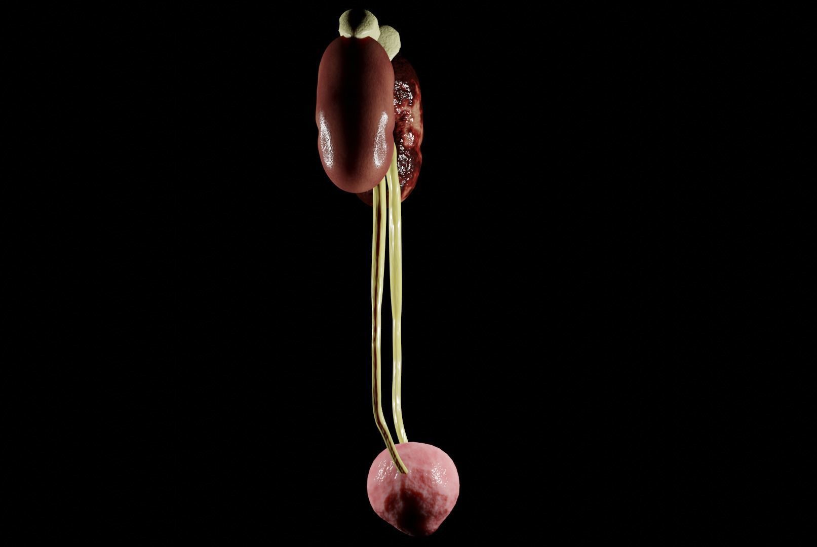 Human Kidney and Urinary System 3D model RENAL CANCER TUMOR 3D model ...