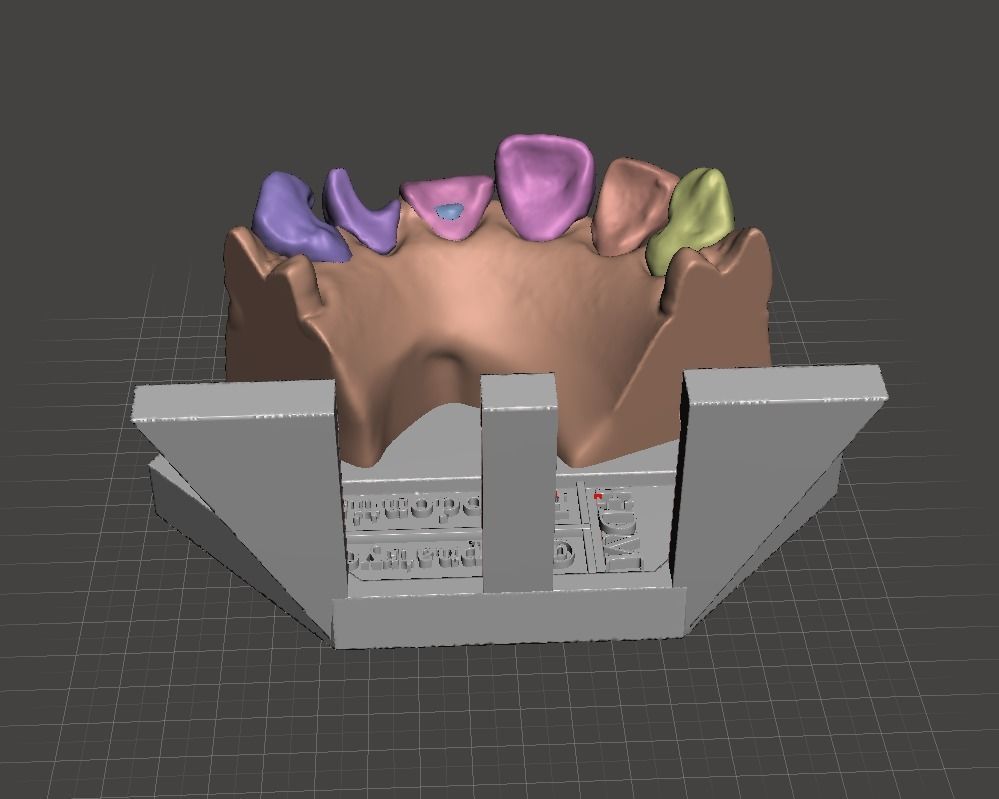 Segmented Anterior Class 5 Class III Class IV Direct Veneer 3D model 3D ...