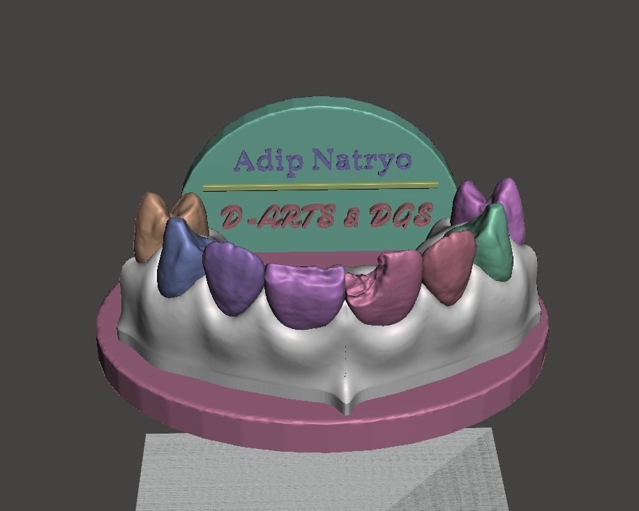 Segmented Anterior Class IV and Class VI by EDM DENTAL PRACTICE 3D ...