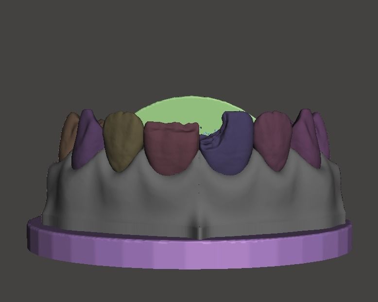 Segmented Anterior Class IV and Class VI by EDM DENTAL PRACTICE 3D ...
