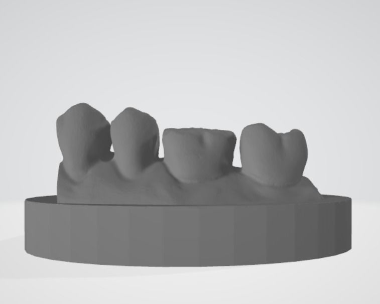 Posterior class 1 MOD Cups Reduction Class II by EDM DENTAL 3D model 3D ...