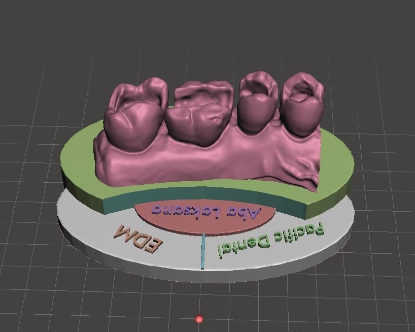 Posterior class 1 MOD Cups Reduction Class II by EDM DENTAL 3D model 3D ...