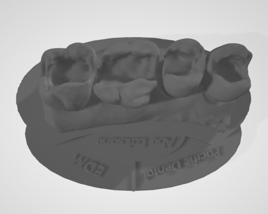 Posterior class 1 MOD Cups Reduction Class II by EDM DENTAL 3D model 3D ...