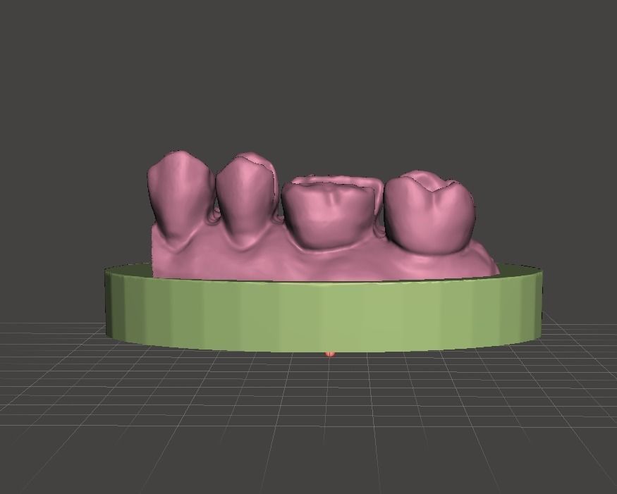 Posterior class 1 MOD Cups Reduction Class II by EDM DENTAL 3D model 3D ...