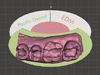 Posterior class 1 MOD Cups Reduction Class II by EDM DENTAL 3D model 3D ...