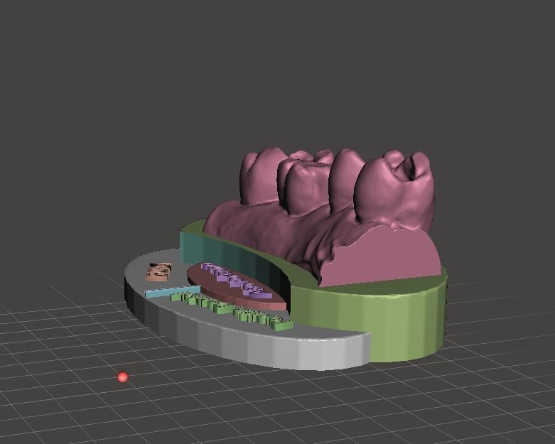Posterior class 1 MOD Cups Reduction Class II by EDM DENTAL 3D model 3D ...