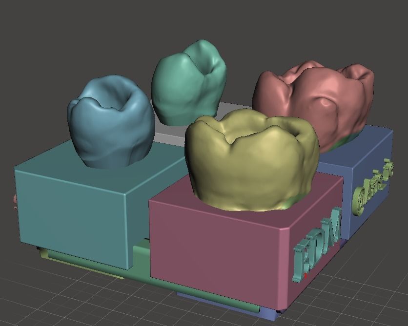 Posterior Block Class 1 by EDM DENTAL PRACTICE 3D model 3D printable ...