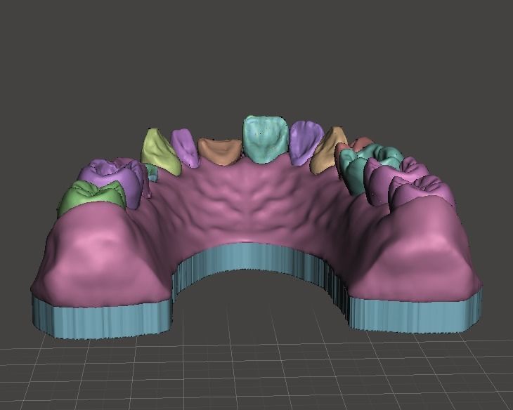 Segmented Full Mixed Arch Complex Cases by EDM DENTAL PRACTICE 3D model ...
