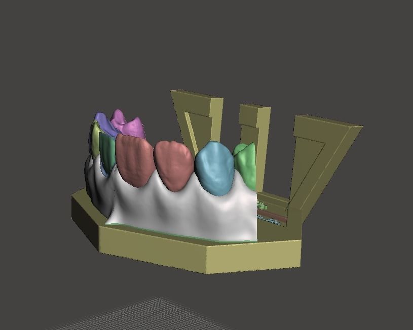 Segmented Anterior Direct Veneer by EDM DENTAL PRACTICE 3D model 3D ...