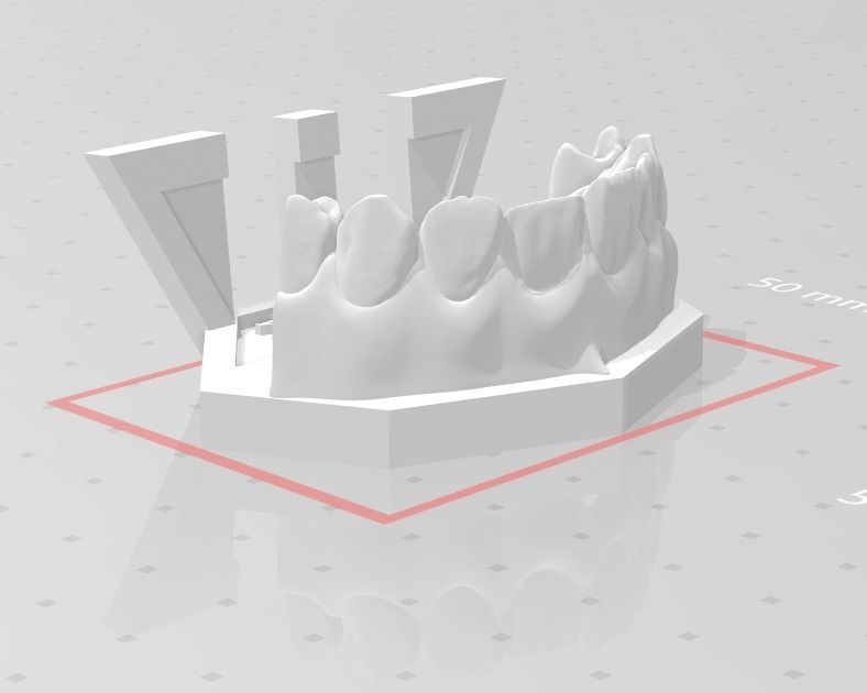 Segmented Anterior Direct Veneer by EDM DENTAL PRACTICE 3D model 3D ...