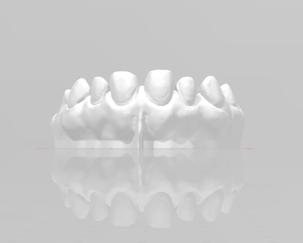 Segmented Anterior Veneer Preparation by EDM DENTAL PRACTICE 3D model ...