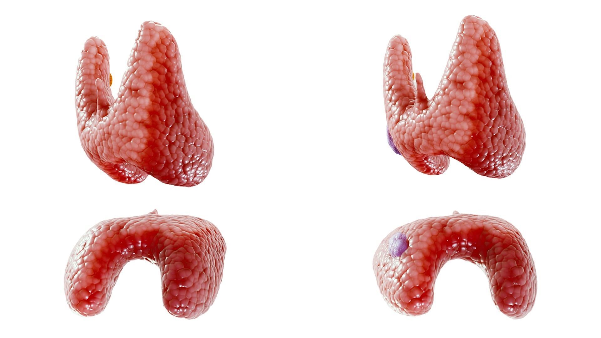 3D model Healthy Thyroid and Thyroid Cancer VR / AR / low-poly | CGTrader
