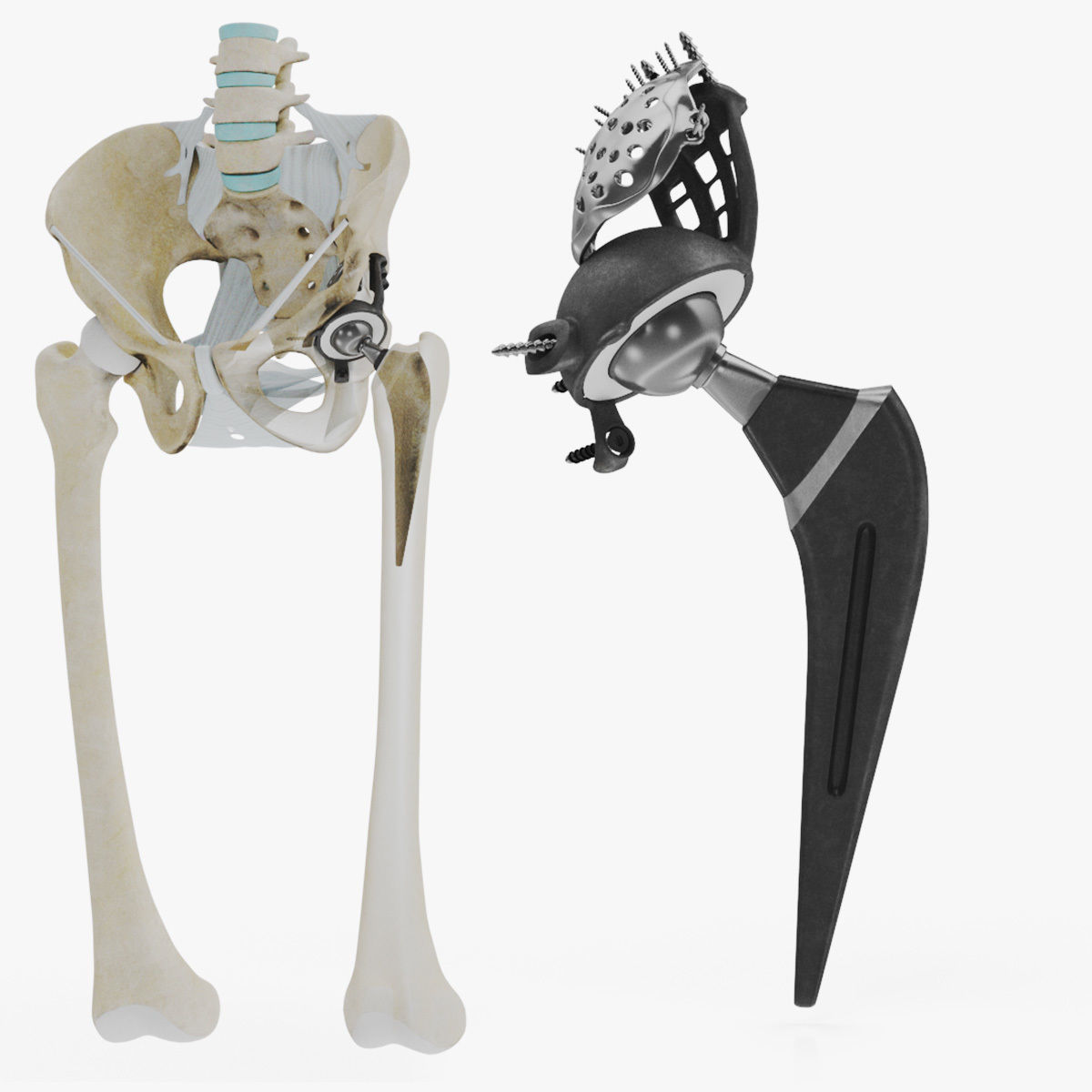 3D model Replaced Pelvic Implant VR / AR / low-poly | CGTrader