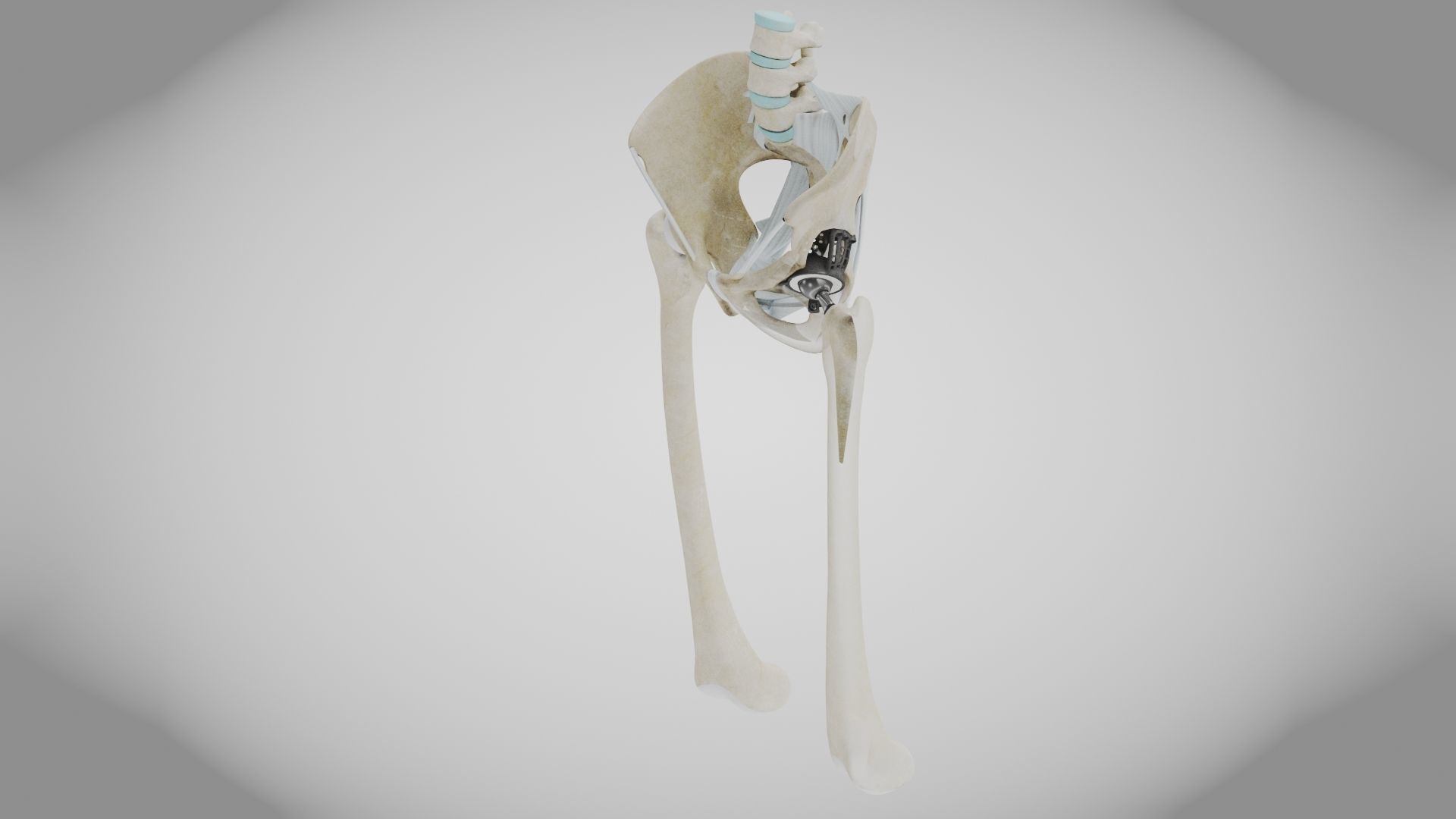 3D model Replaced Pelvic Implant VR / AR / low-poly | CGTrader