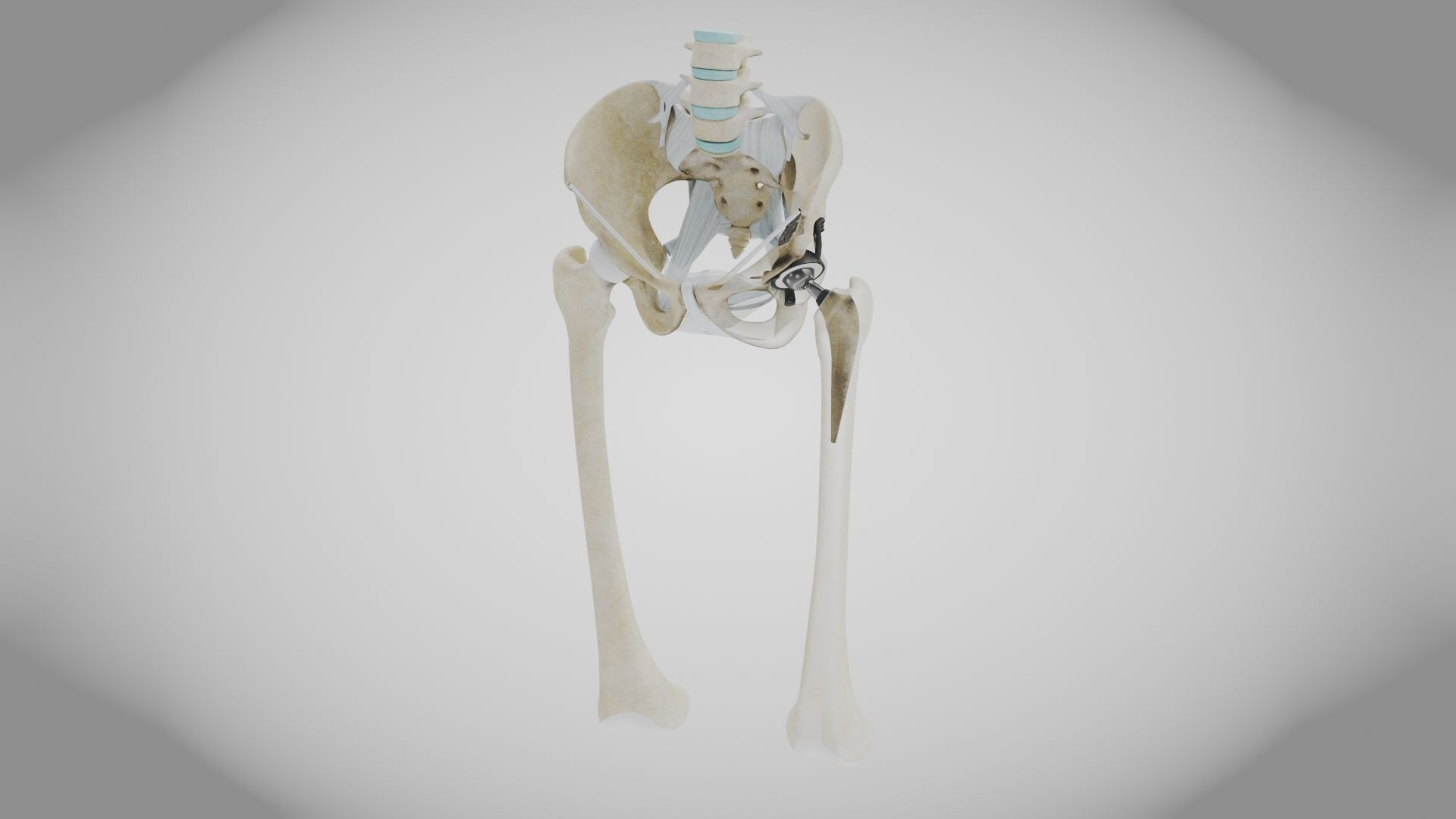 3D model Replaced Pelvic Implant VR / AR / low-poly | CGTrader