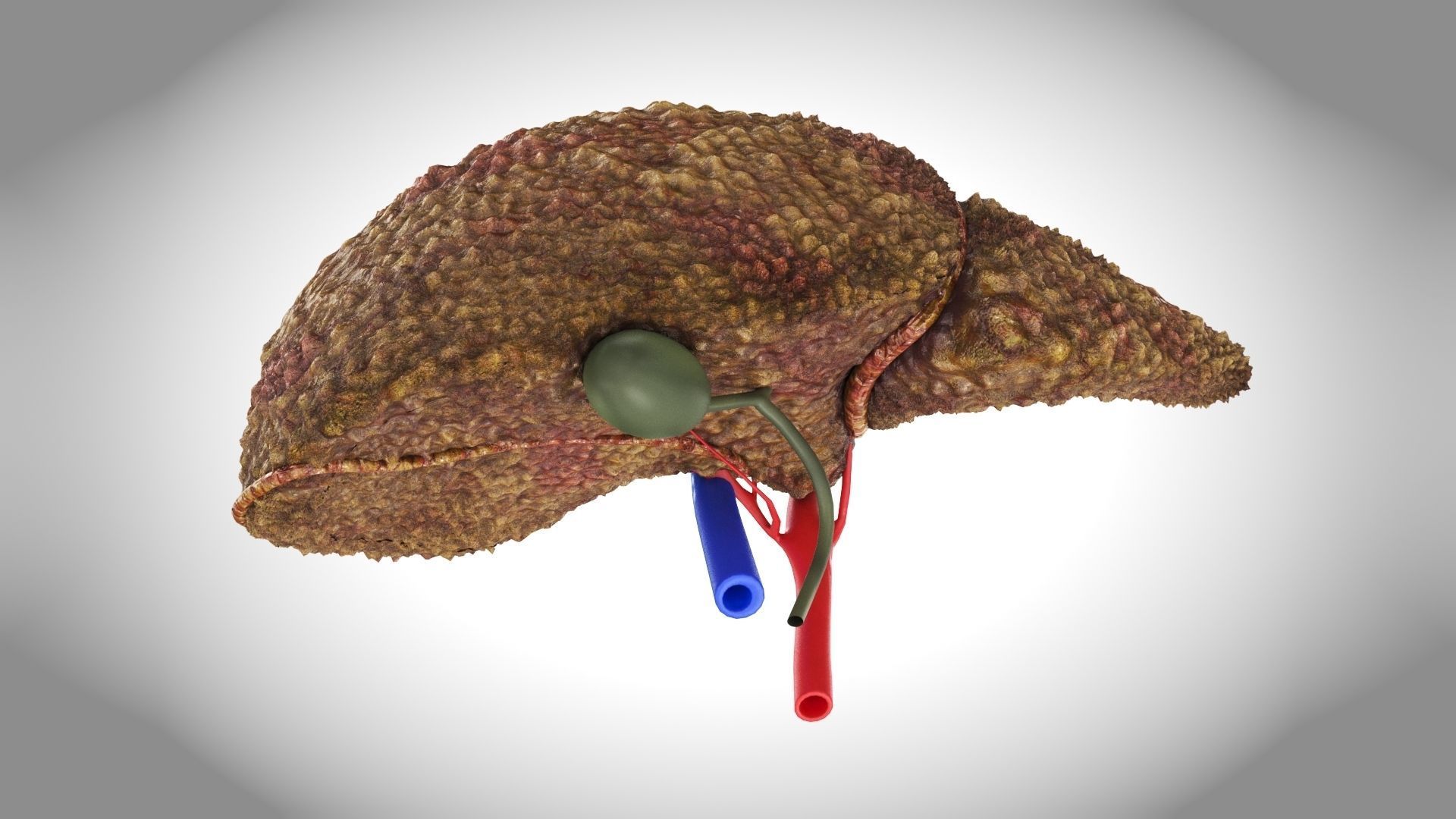 3D model Liver Diseases VR / AR / low-poly | CGTrader