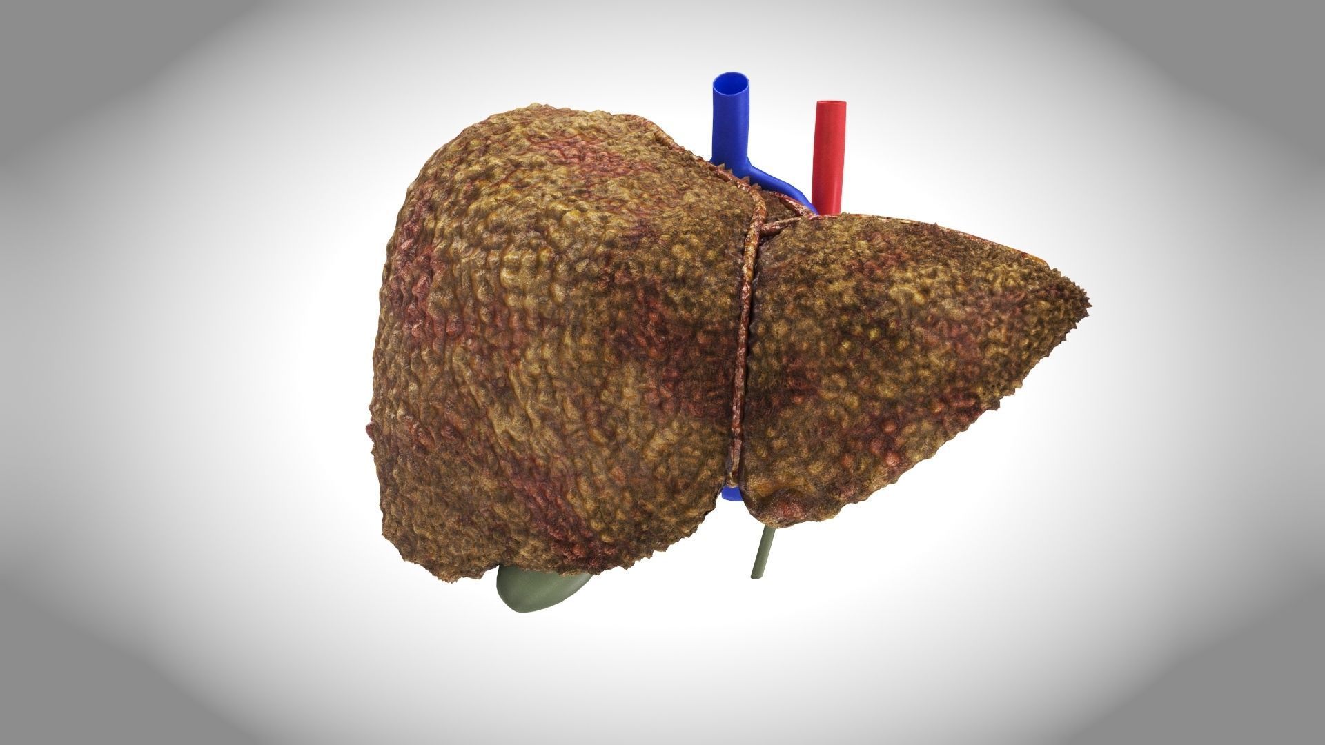 3D model Liver Diseases VR / AR / low-poly | CGTrader