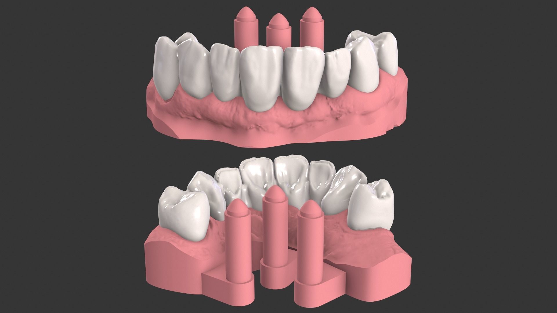 Dental Anatomy Bridge Real medical case 3D model 3D printable | CGTrader