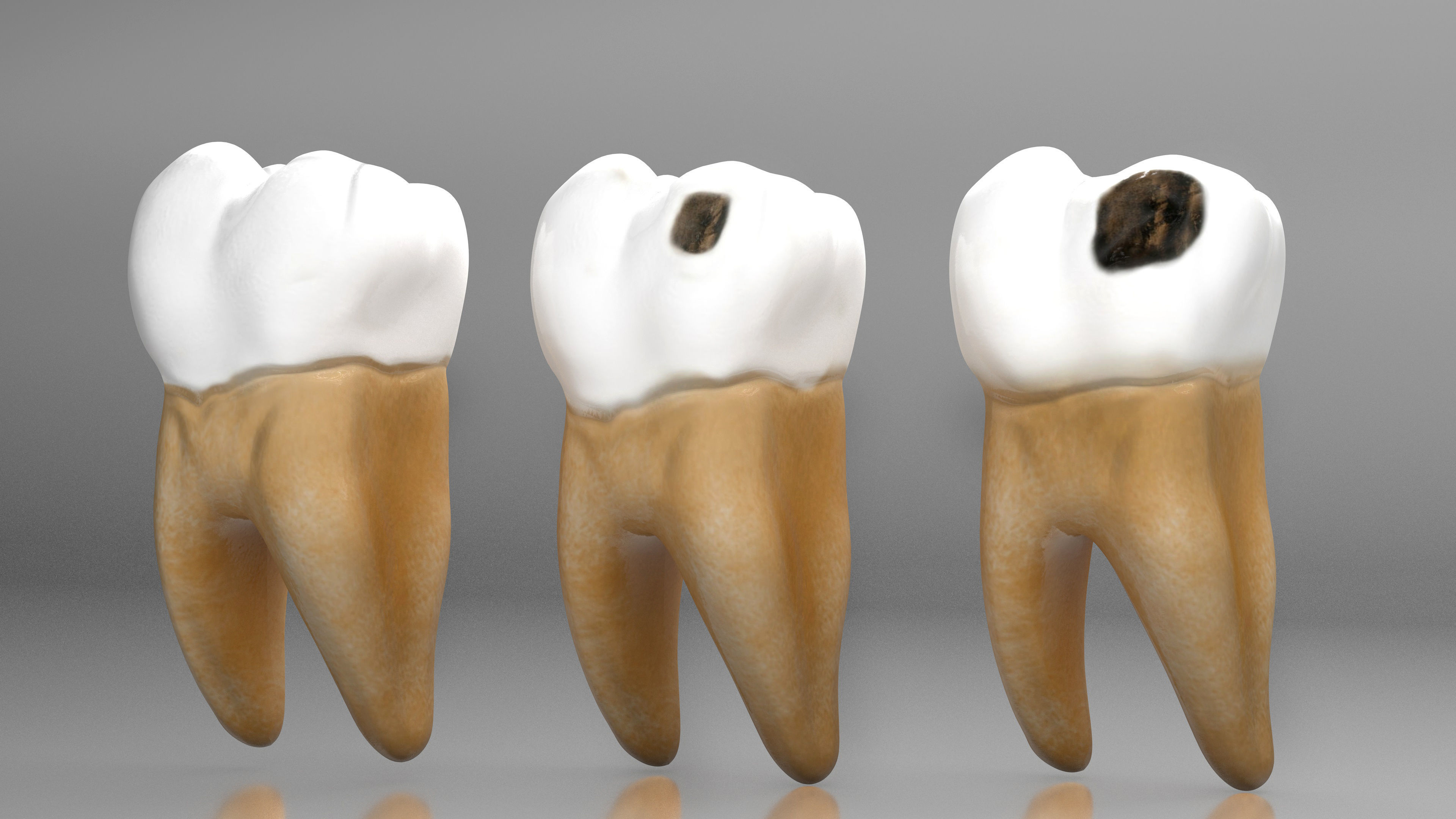 3D model Human Tooth Decay A 3D Dental Caries Progression Model VR / AR ...